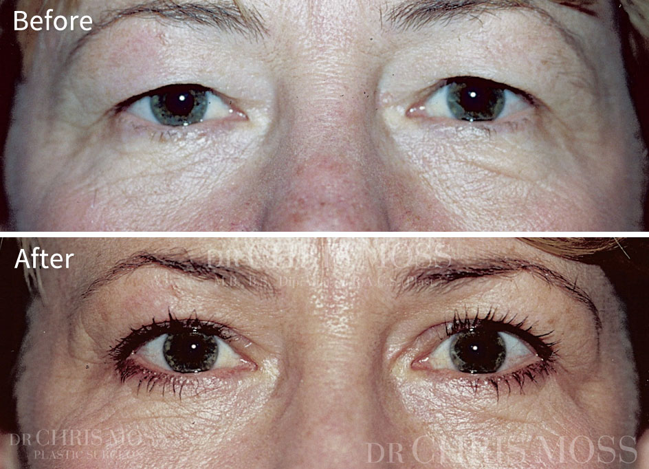 Eyelid Surgery Before & After | Dr Chris Moss Plastic Surgeon